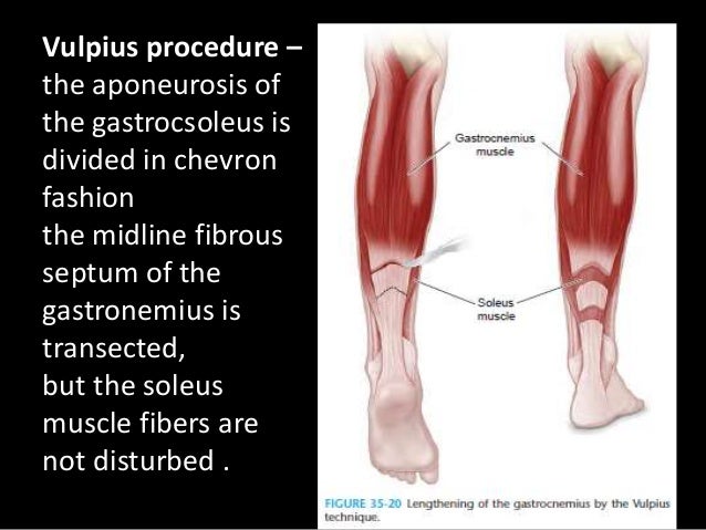 Cerebral palsy by DR.NAVEEN RATHOR