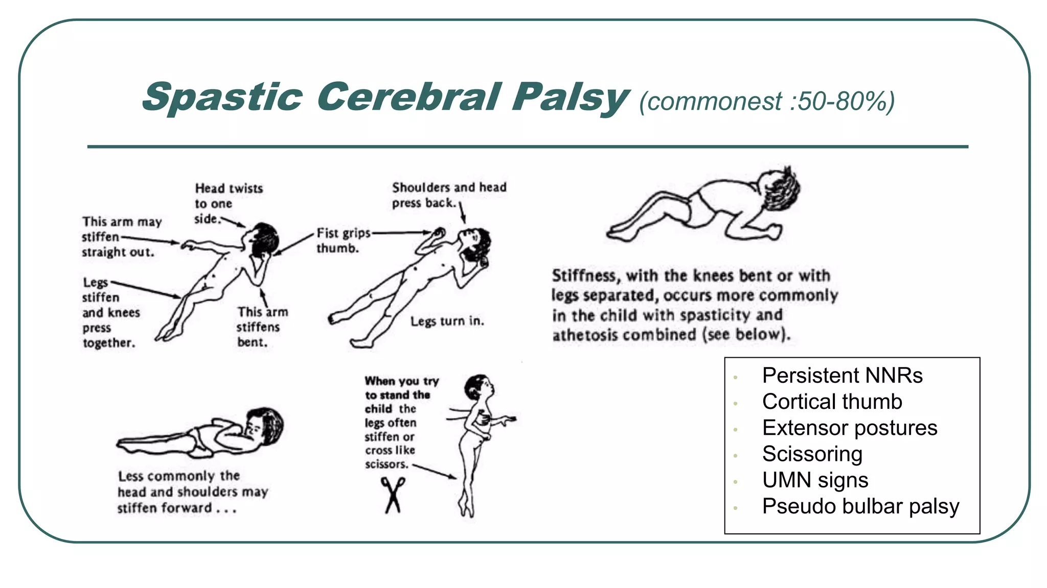 Cerebral Palsy | PPTX