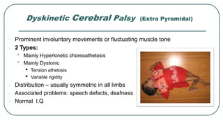 Dyskinetic Cerebral Palsy