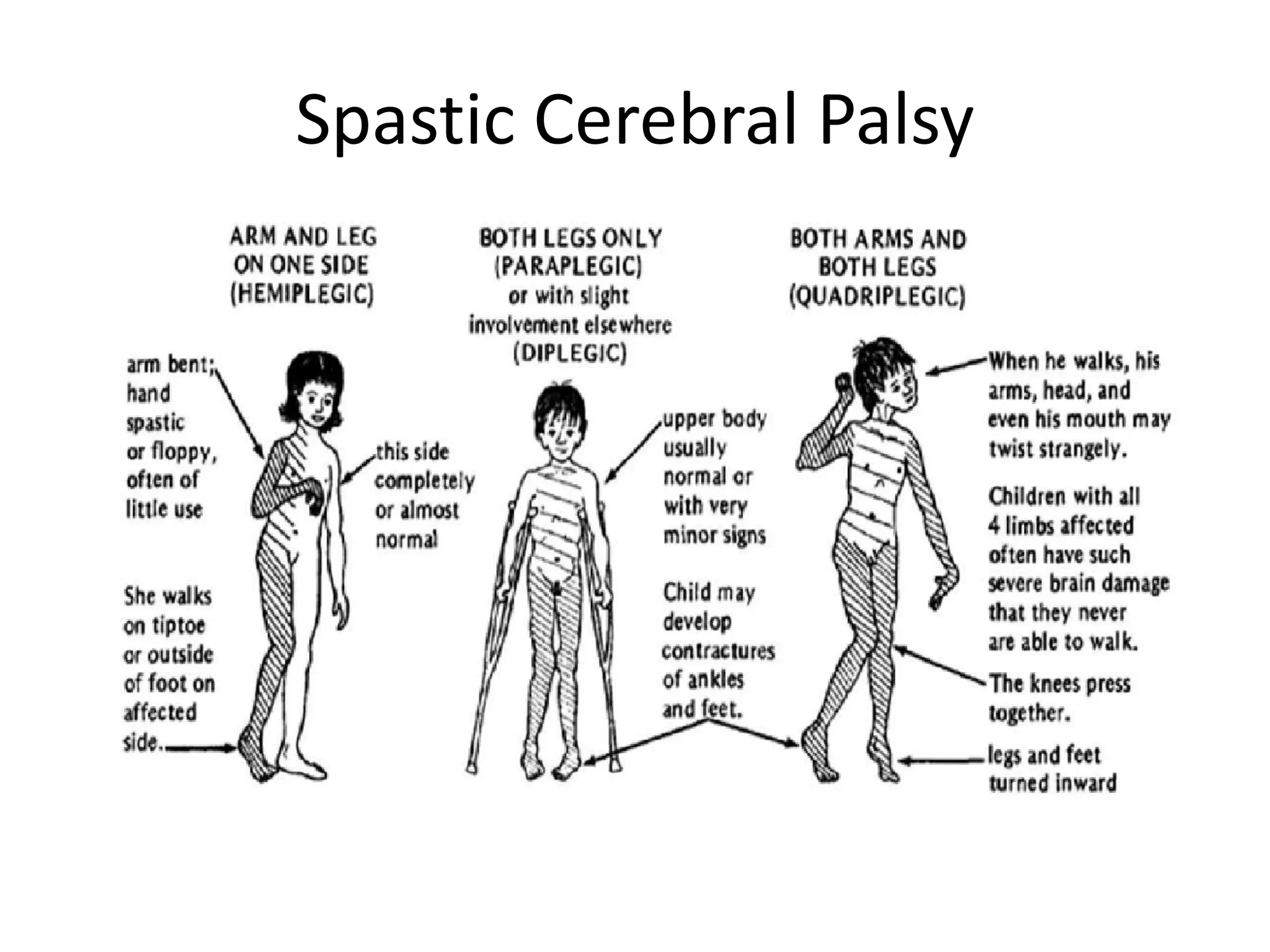 Cerebral Palsy.pptx