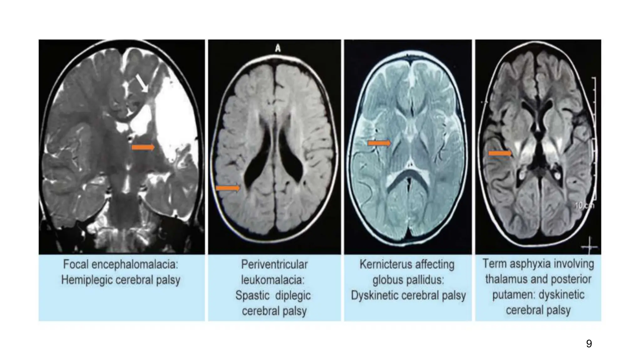 CEREBRAL PALSY.pptx