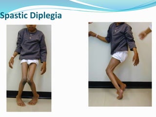 CEREBRAL PALSY.pptx by John wambugu ..a clinical officer paediatrician ...