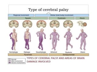 Cerebral palsy introduction pathogenesis treatment and management | PPTX