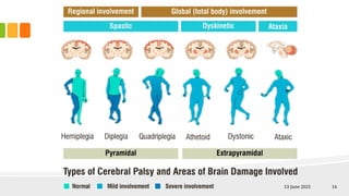CEREBRAL PALSY - classification, types and Management | PPTX