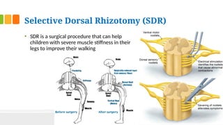 CEREBRAL PALSY - classification, types and Management | PPTX