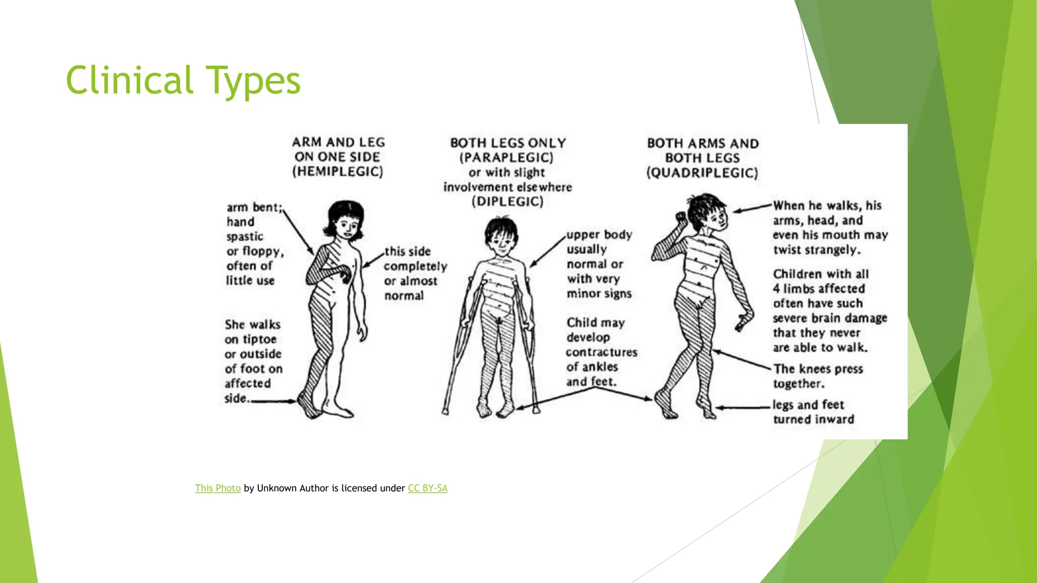 Cerebral Palsy | PPTX
