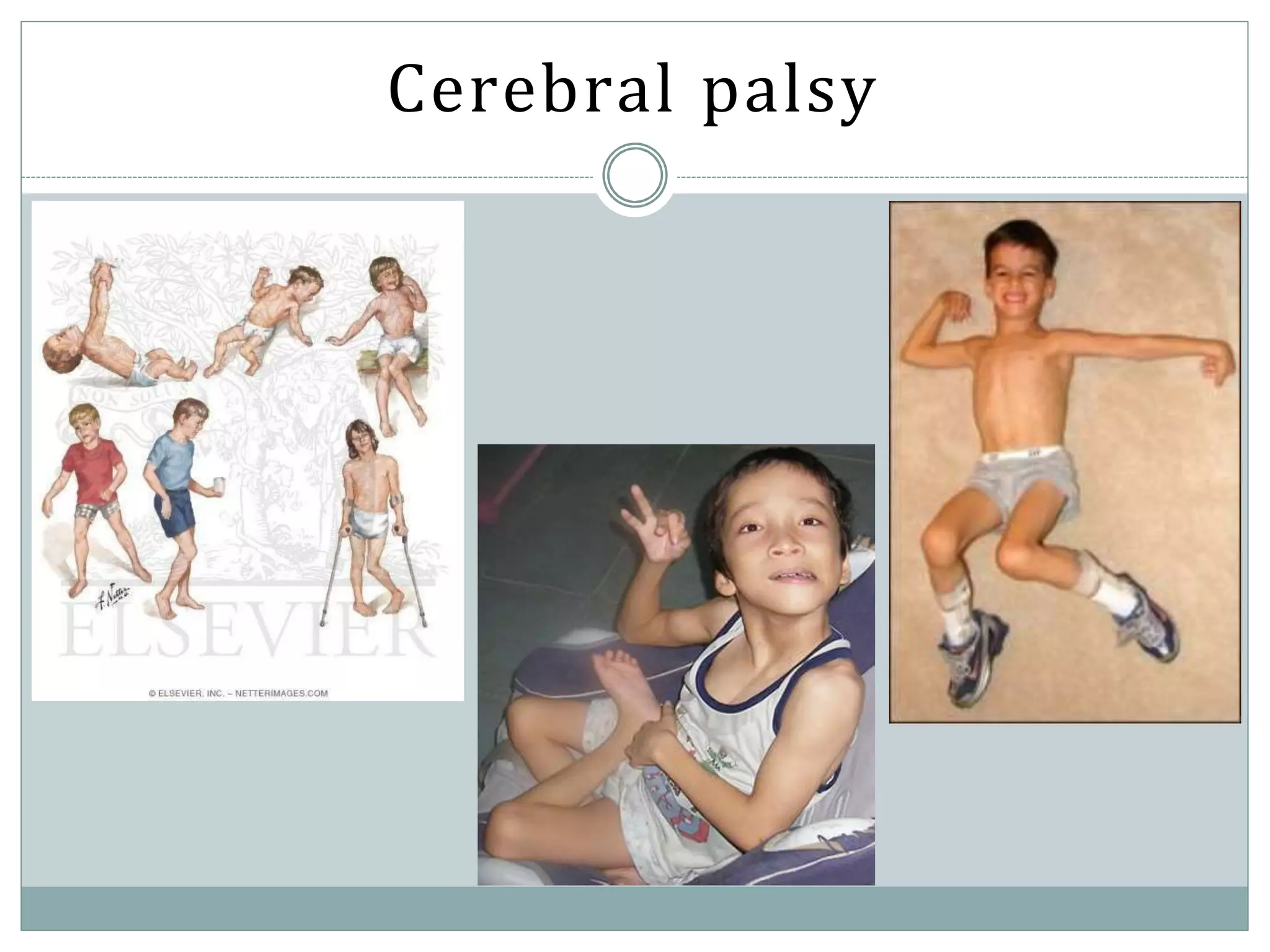 cerebralpalsy-ppt.pptx