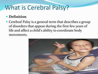 Cerebral palsy (2) | PPTX