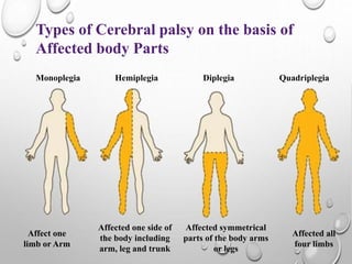 Cerebral palsy by shivam | PPTX