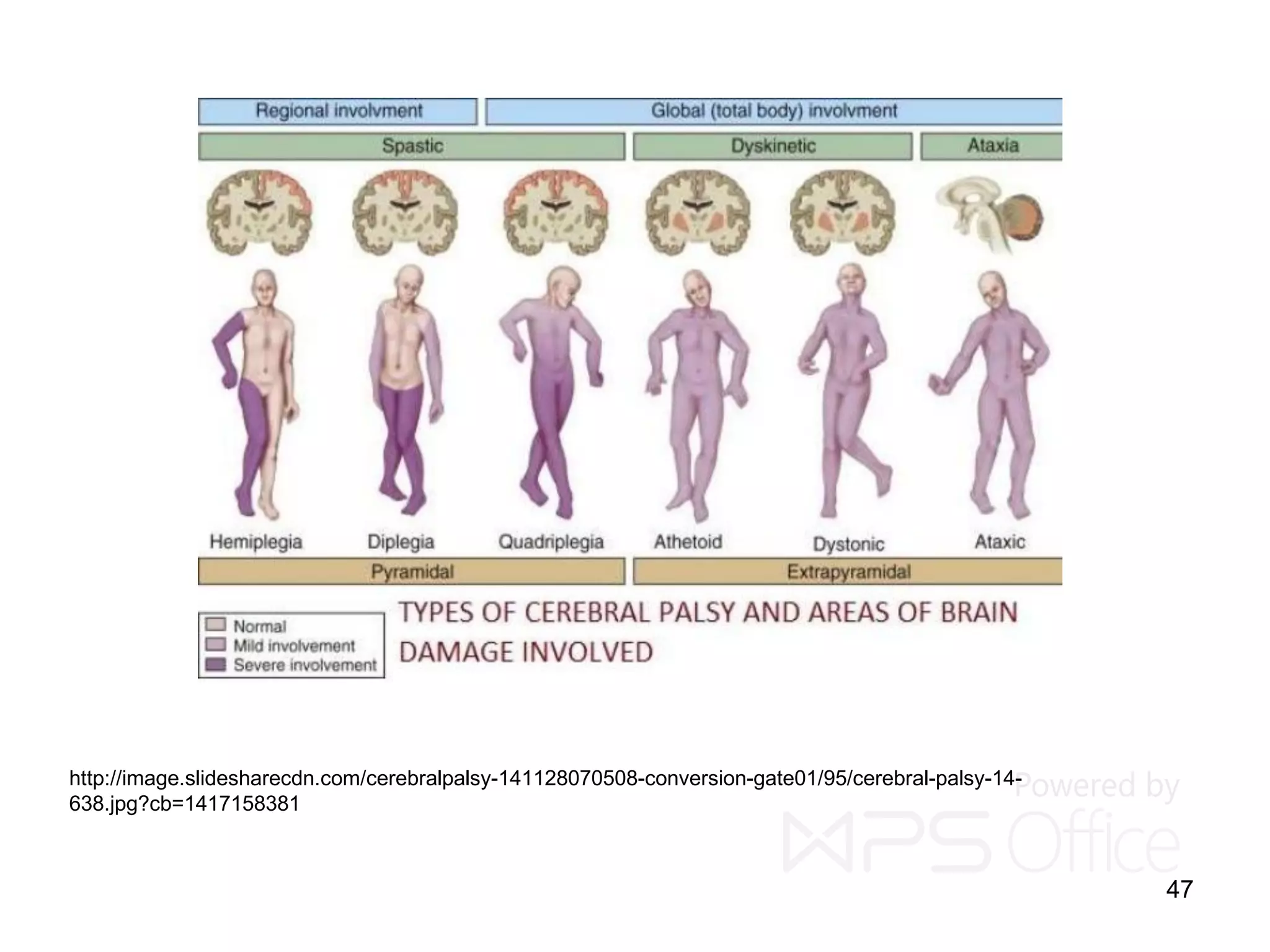 Cerebral palsy- Etiology and Classification | PPT