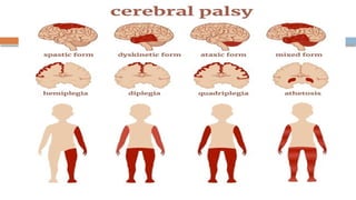 cerebral palsy&mental retardation pediatrics pptx | PPT