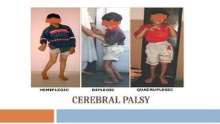 cerebral palsy&mental retardation pediatrics pptx | PPT