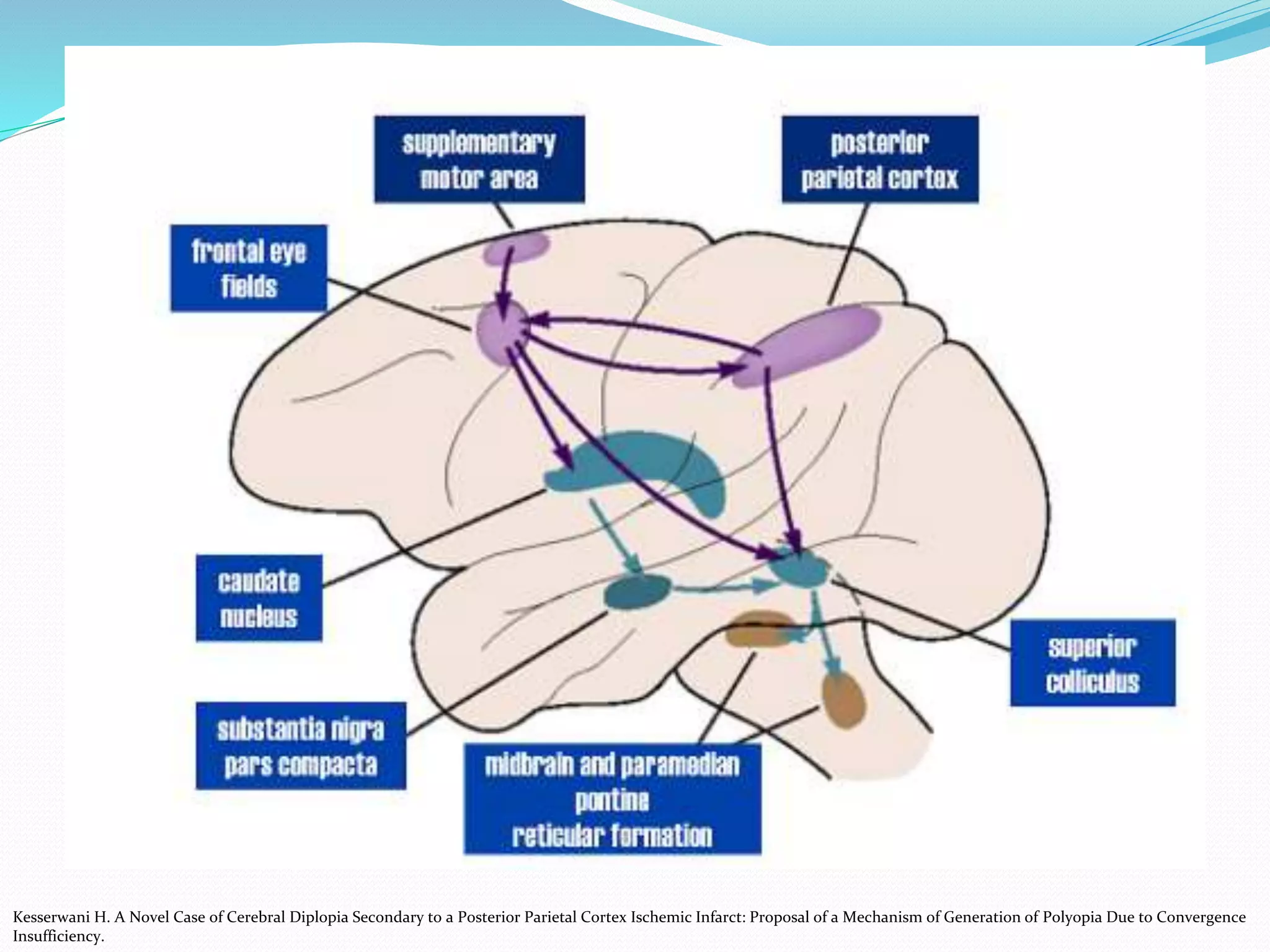 Cerebral Polyopia | PPT