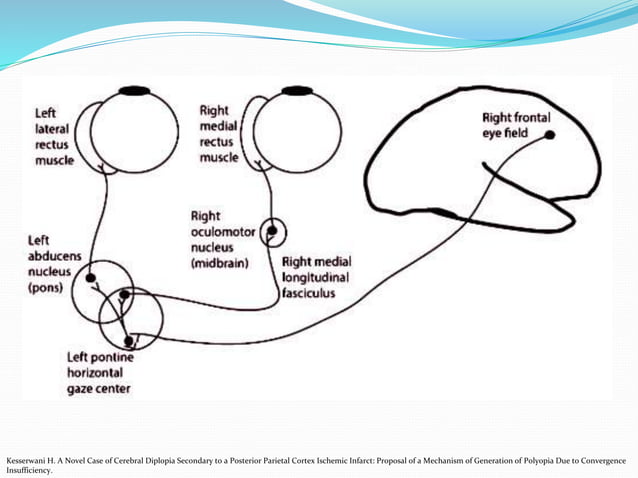 Cerebral Polyopia | PPT