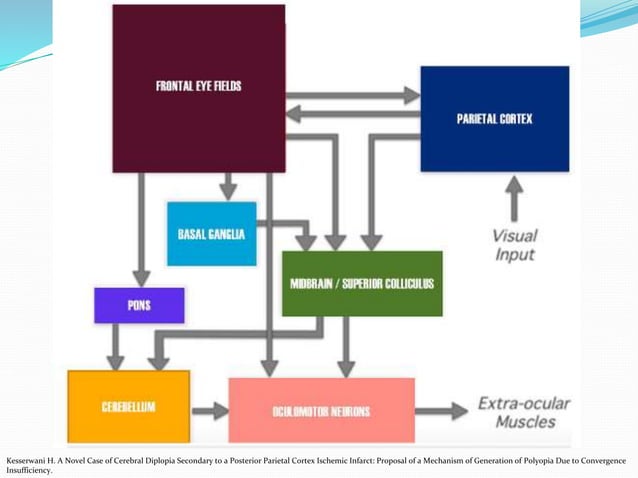 Cerebral Polyopia | PPT