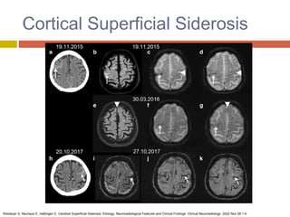 Cerebral Superficial Siderosis.pptx