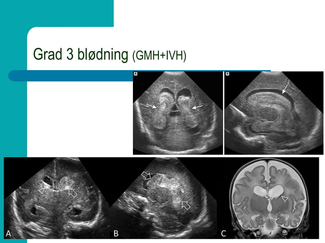 Cerebral ultralyd | PPT