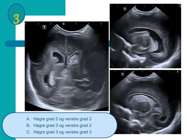 Cerebral ultralyd | PPT