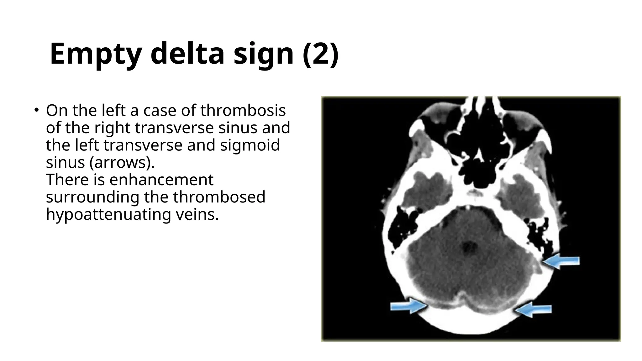 Cerebral Venous Sinus Thrombosis Cerebral Venous Sinus Thrombosis.pptx
