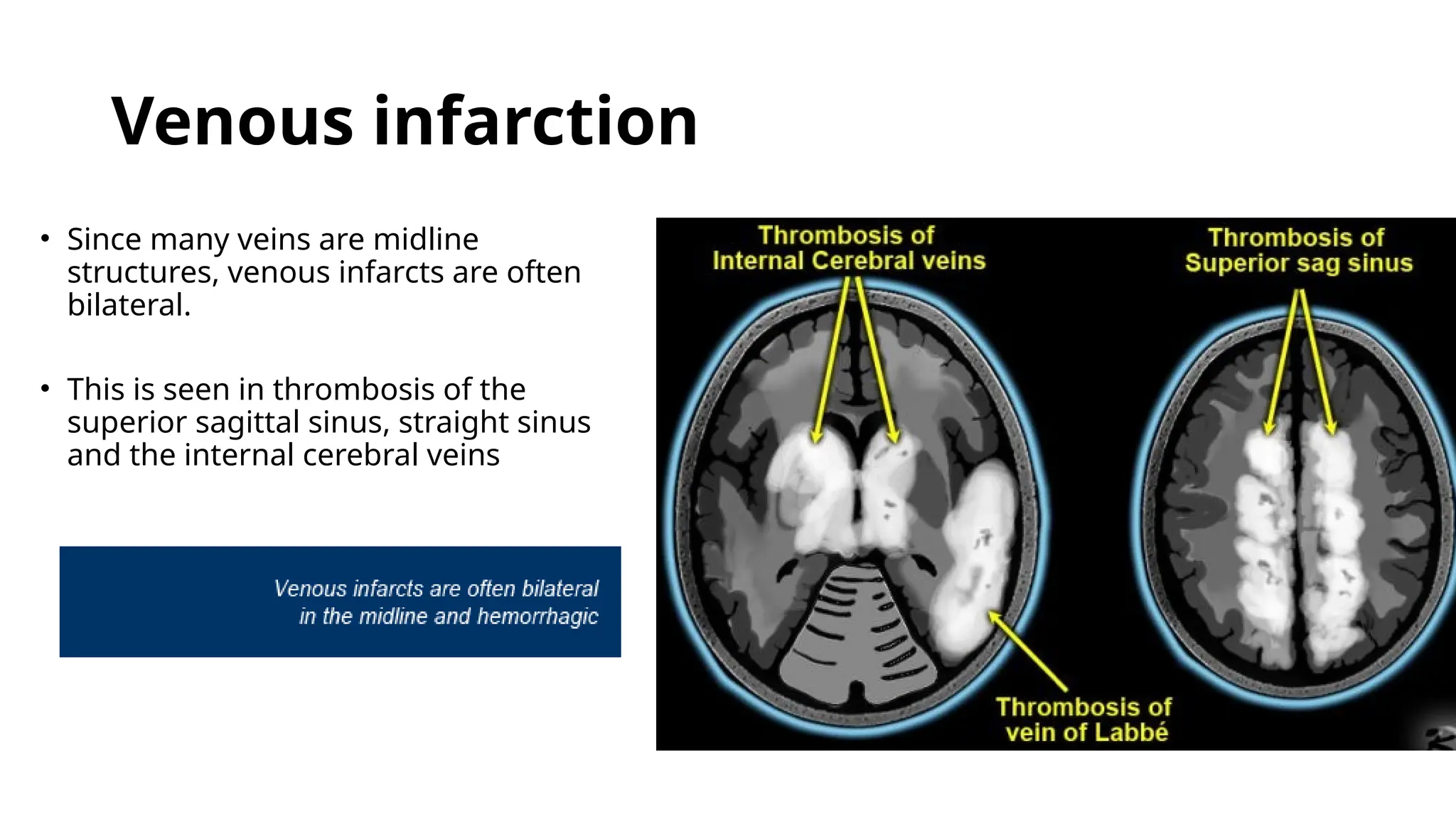 Cerebral Venous Sinus Thrombosis Cerebral Venous Sinus Thrombosis.pptx