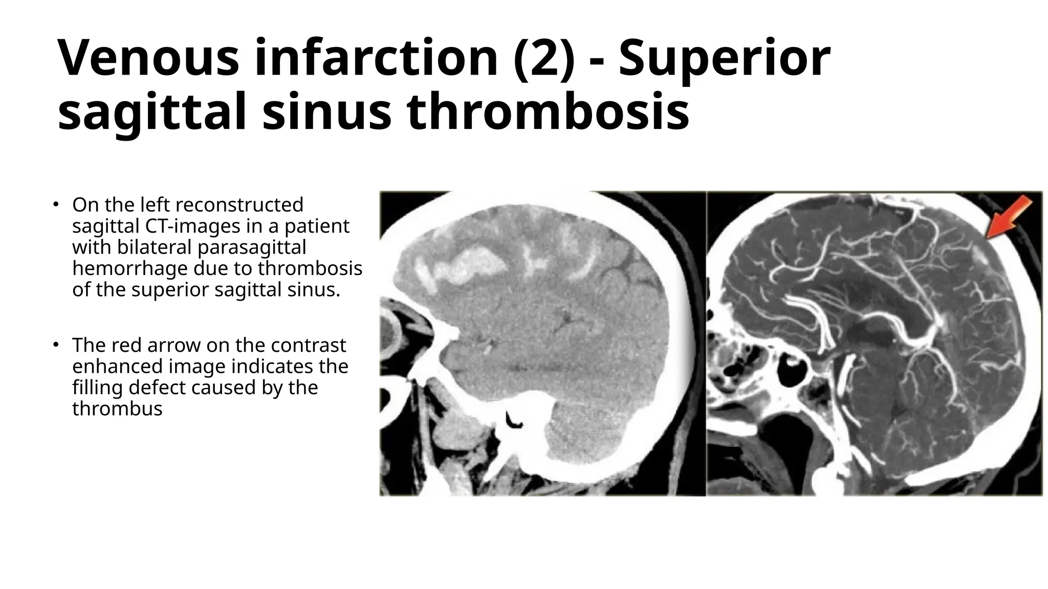 Cerebral Venous Sinus Thrombosis Cerebral Venous Sinus Thrombosis.pptx
