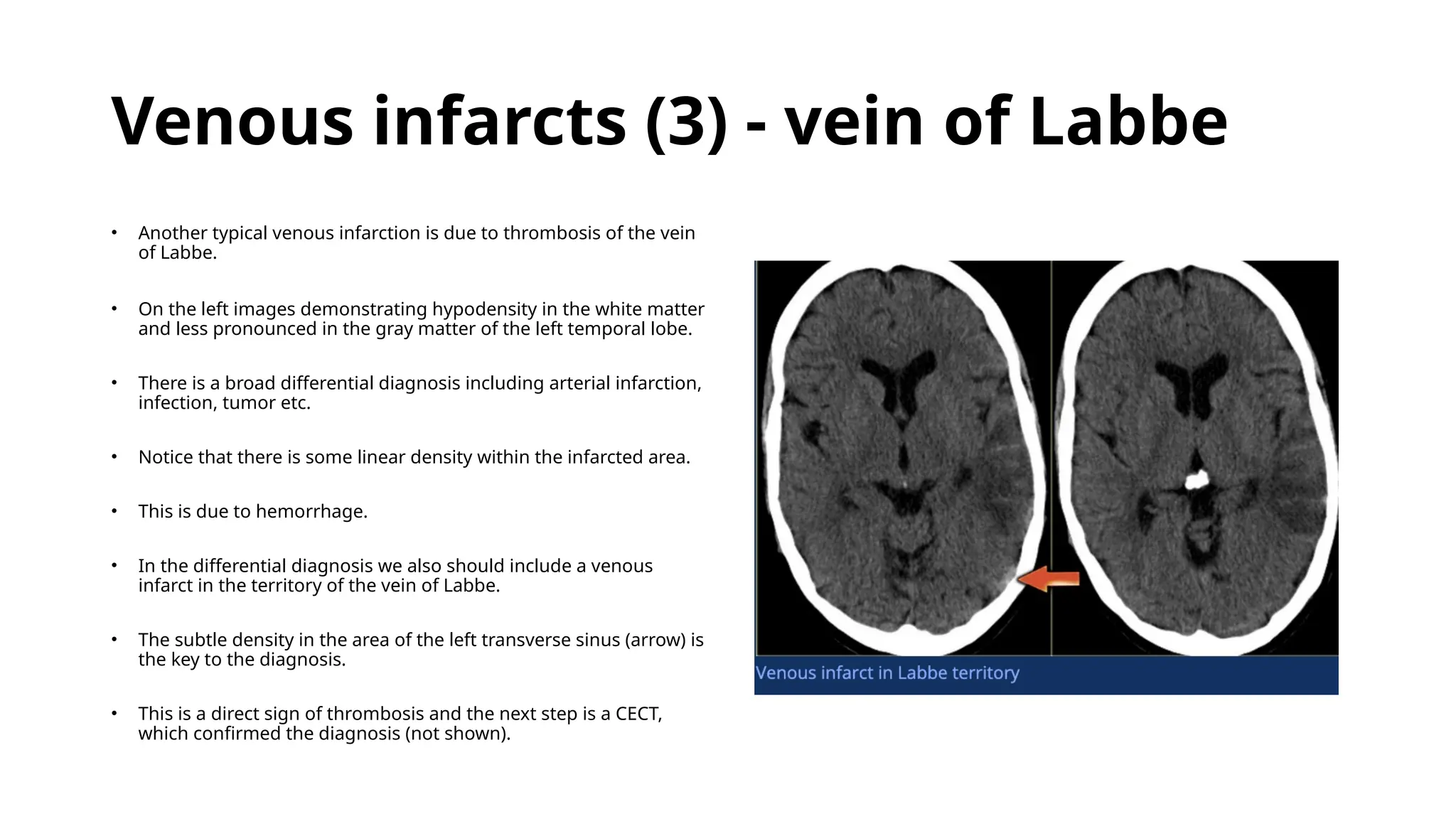 Cerebral Venous Sinus Thrombosis Cerebral Venous Sinus Thrombosis.pptx