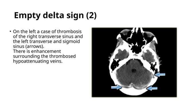 Cerebral Venous Sinus Thrombosis Cerebral Venous Sinus Thrombosis.pptx