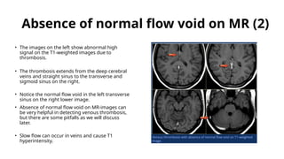 Cerebral Venous Sinus Thrombosis Cerebral Venous Sinus Thrombosis.pptx