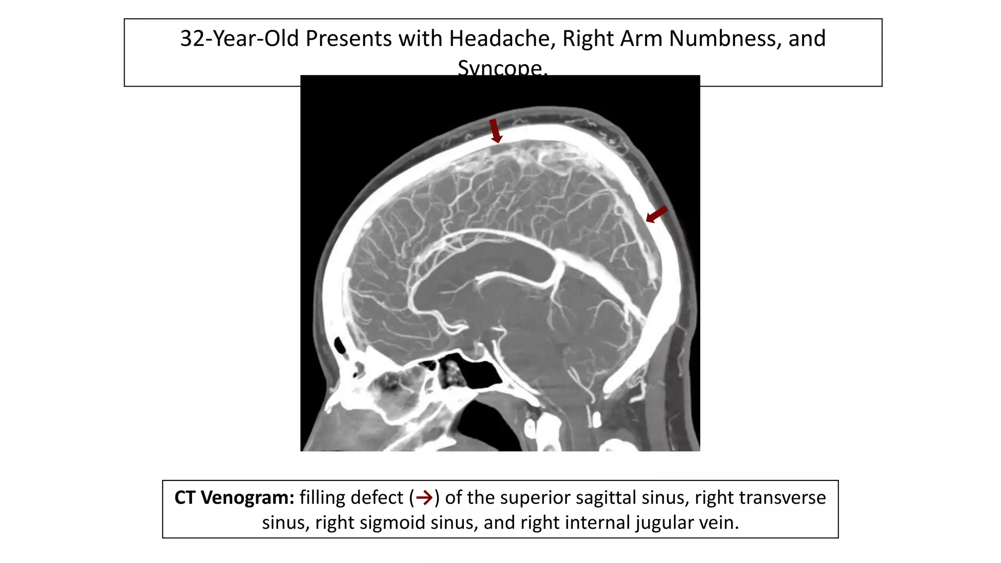CMC Neuroimaging Case Studies - Cerebral Venous Sinus Thrombosis | PPTX