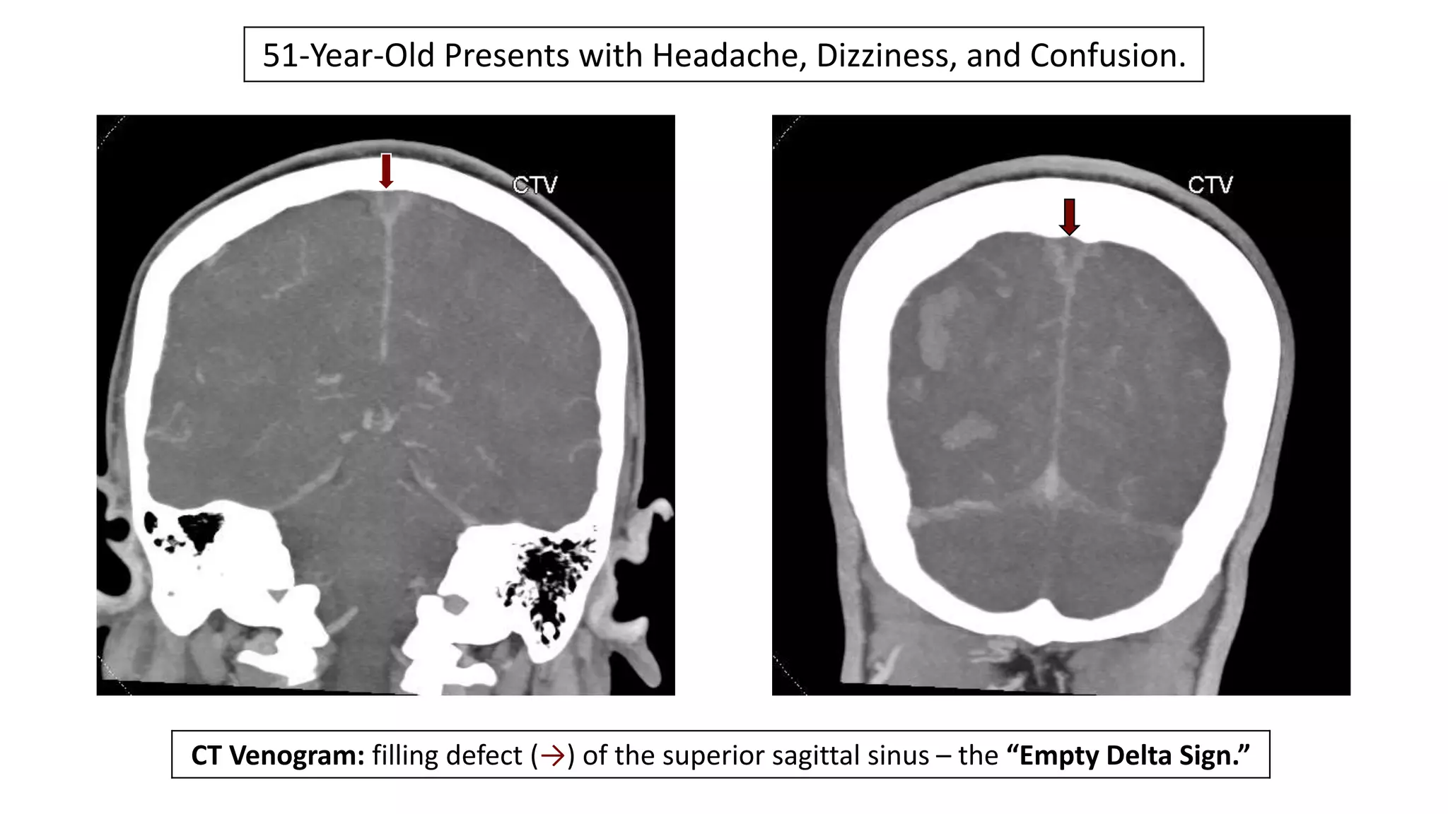 CMC Neuroimaging Case Studies - Cerebral Venous Sinus Thrombosis | PPTX