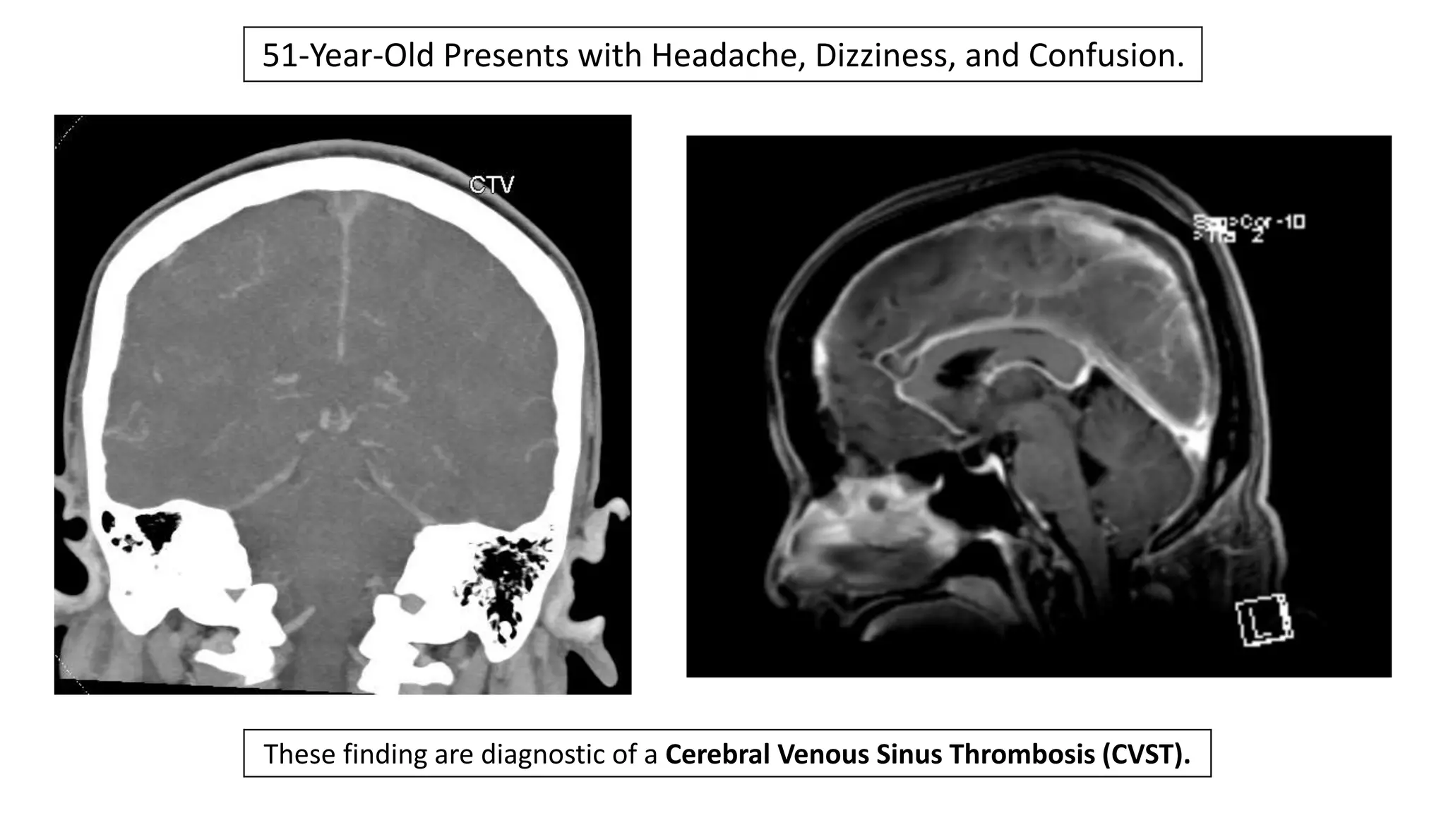 CMC Neuroimaging Case Studies - Cerebral Venous Sinus Thrombosis | PPTX
