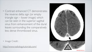 Cerebral sinuses venous thrombosis | PDF