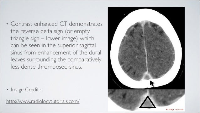 Cerebral sinuses venous thrombosis