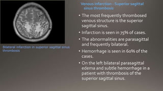 Cerebral venous thrombosis | PPT