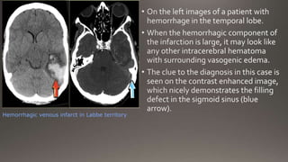 Cerebral venous thrombosis | PPT