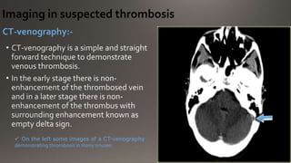 Cerebral venous thrombosis | PPTX
