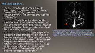Cerebral venous thrombosis | PPT | Free Download