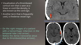 Cerebral venous thrombosis | PPT