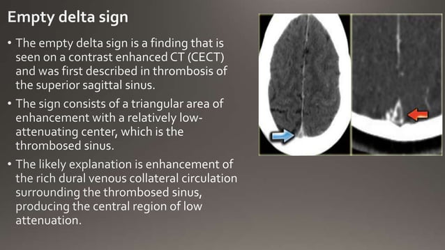 Cerebral venous thrombosis | PPT