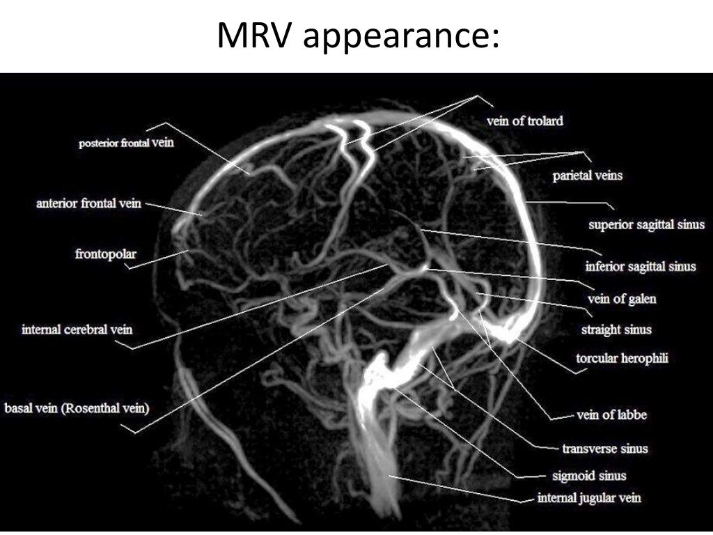 Cerebral venous thrombosis- Treatment