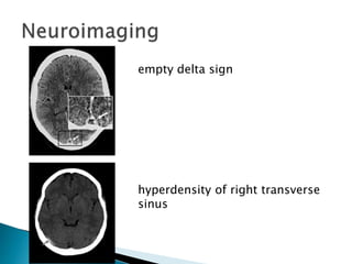 Cerebral venous thrombosis and protein S deficiency.pptx