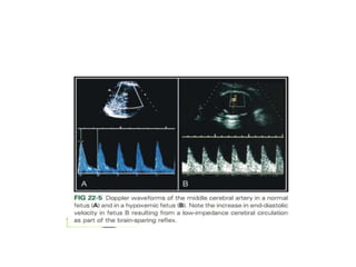 Antenatal doppler and cerebroplacental ratio pptx | PPTX