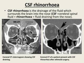 Cerebrospinal fluid | PPTX