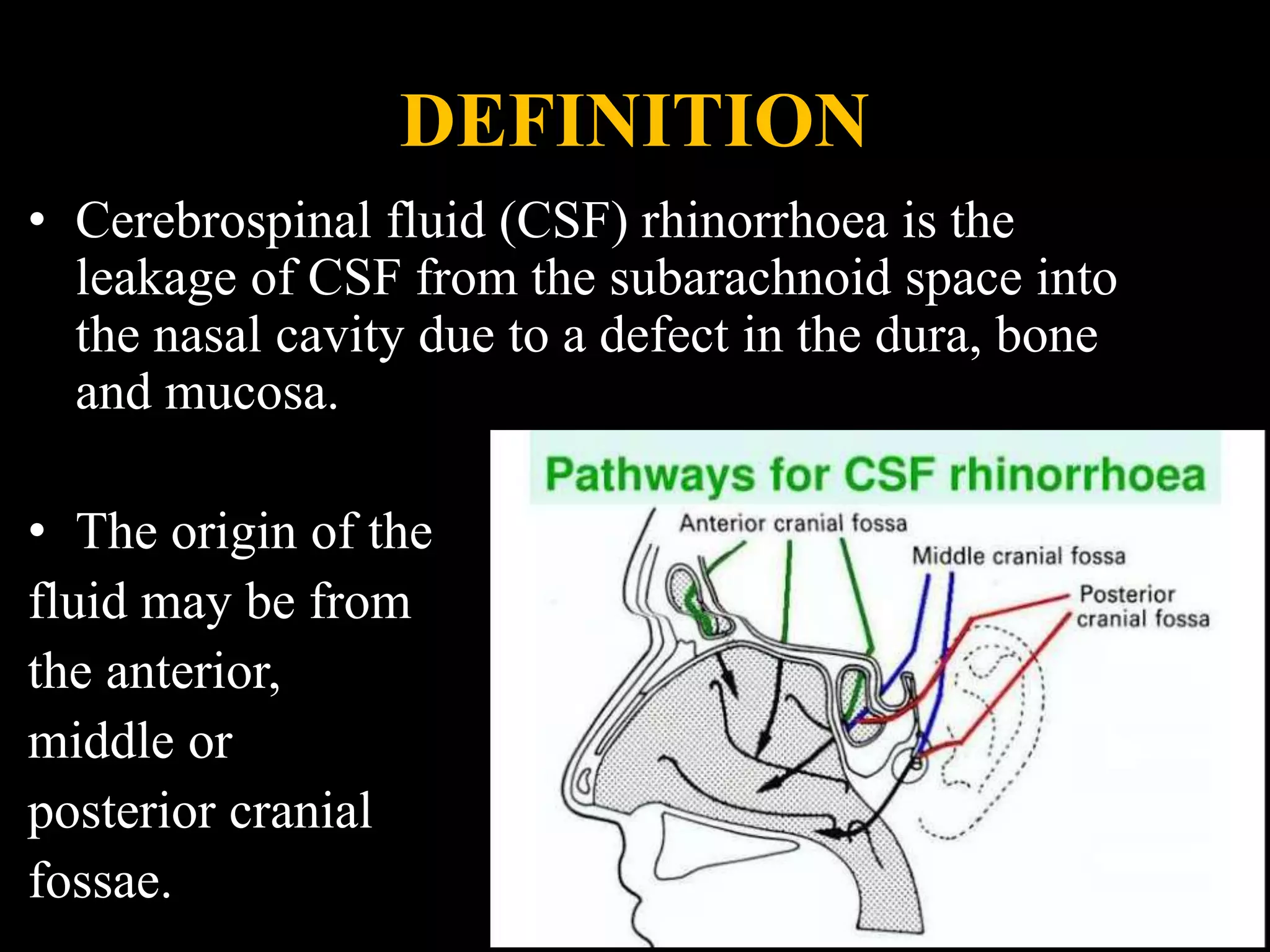 Cerebrospinal fluid rhinorrhea (CSF) | PPTX