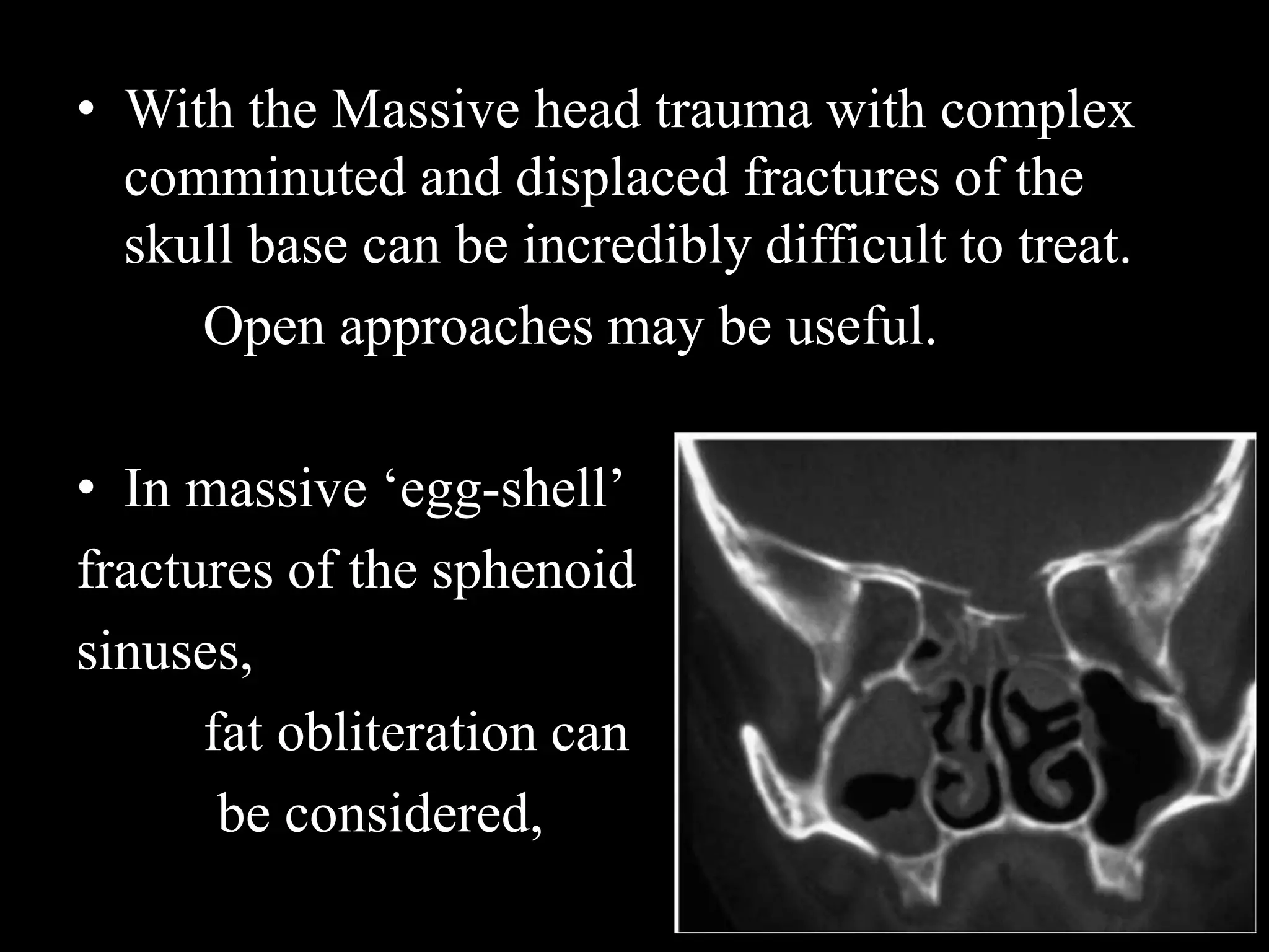 Cerebrospinal fluid rhinorrhea (CSF) | PPTX