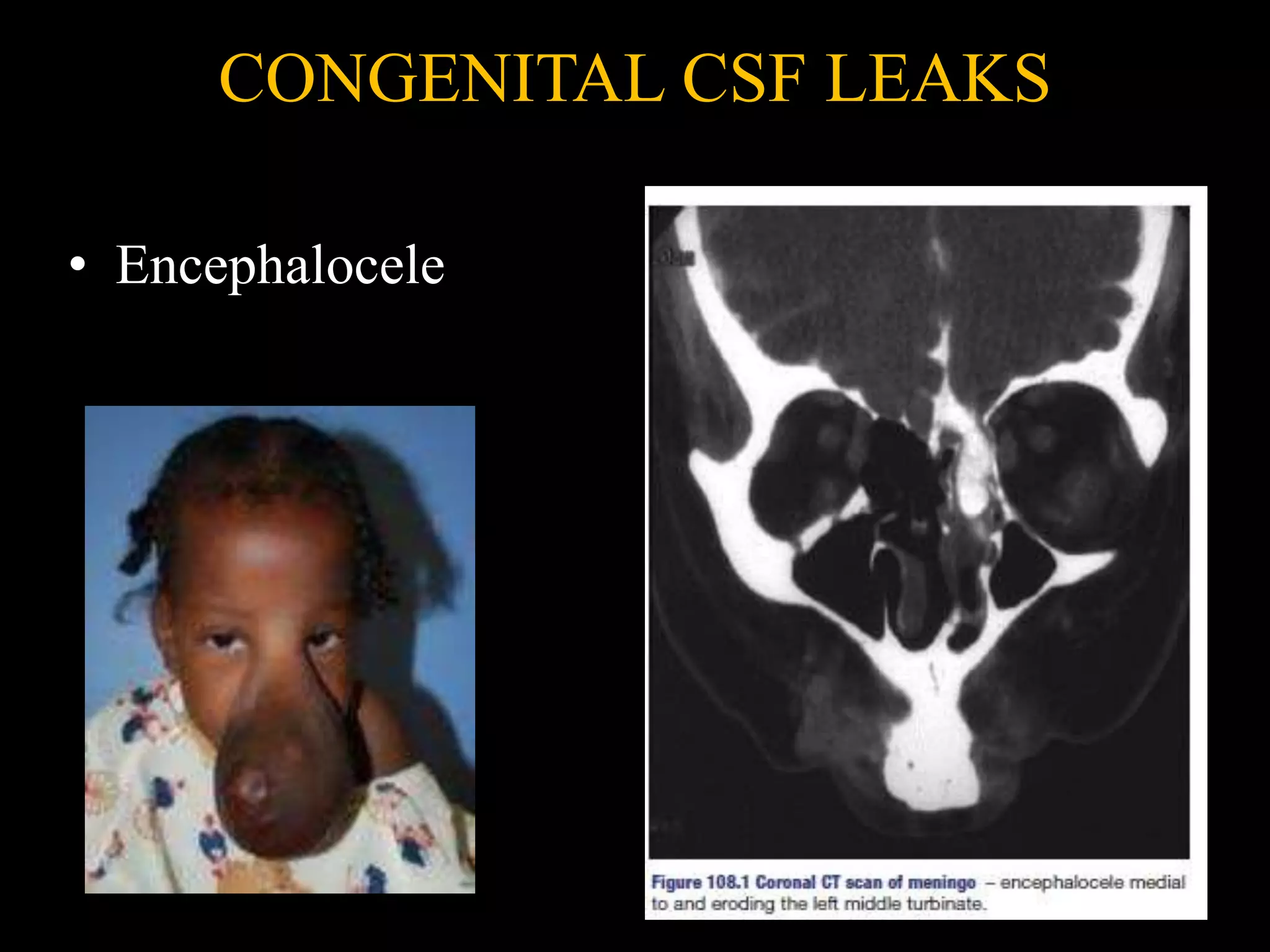 Cerebrospinal fluid rhinorrhea (CSF) | PPTX
