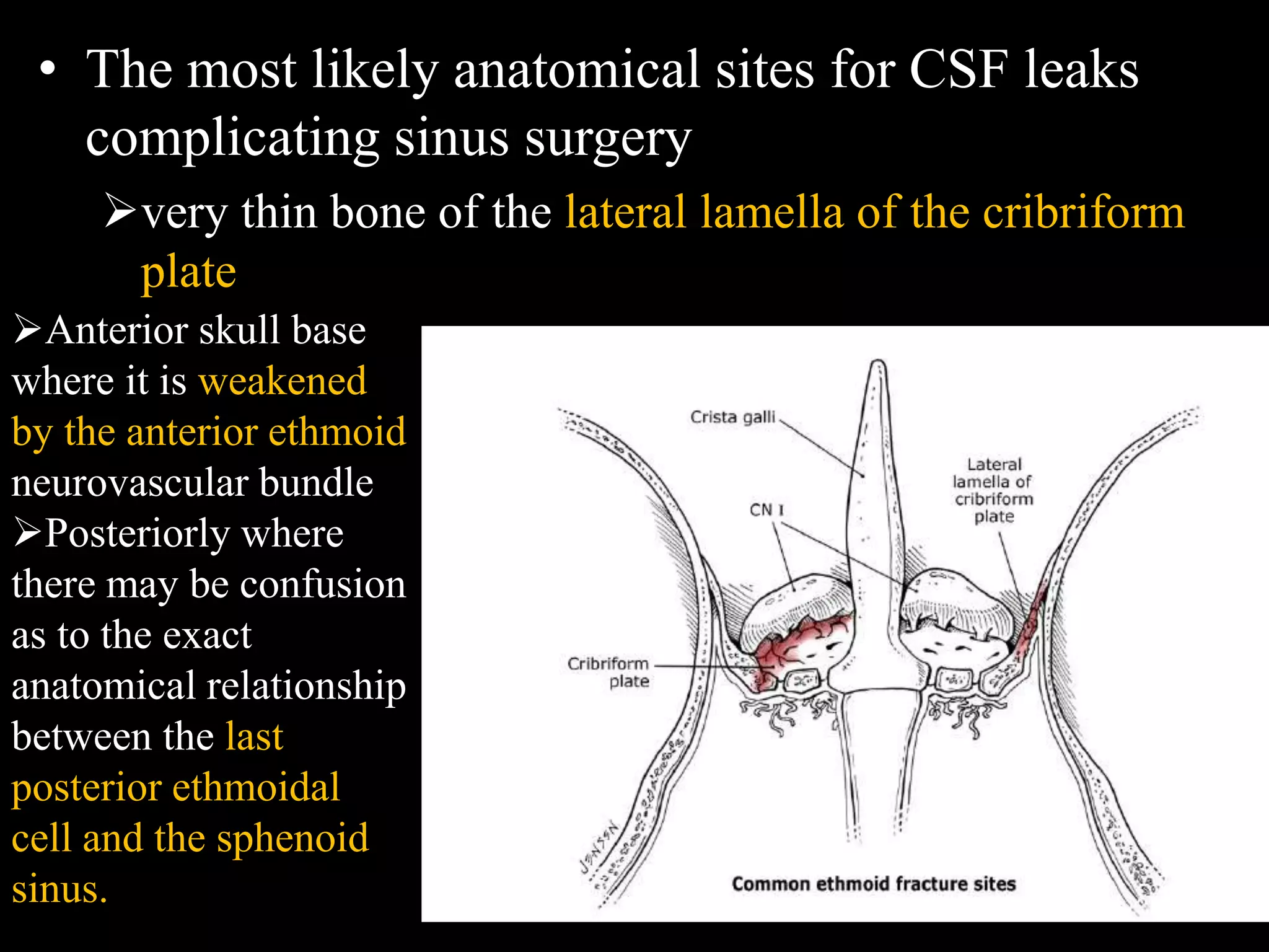 Cerebrospinal fluid rhinorrhea (CSF) | PPTX