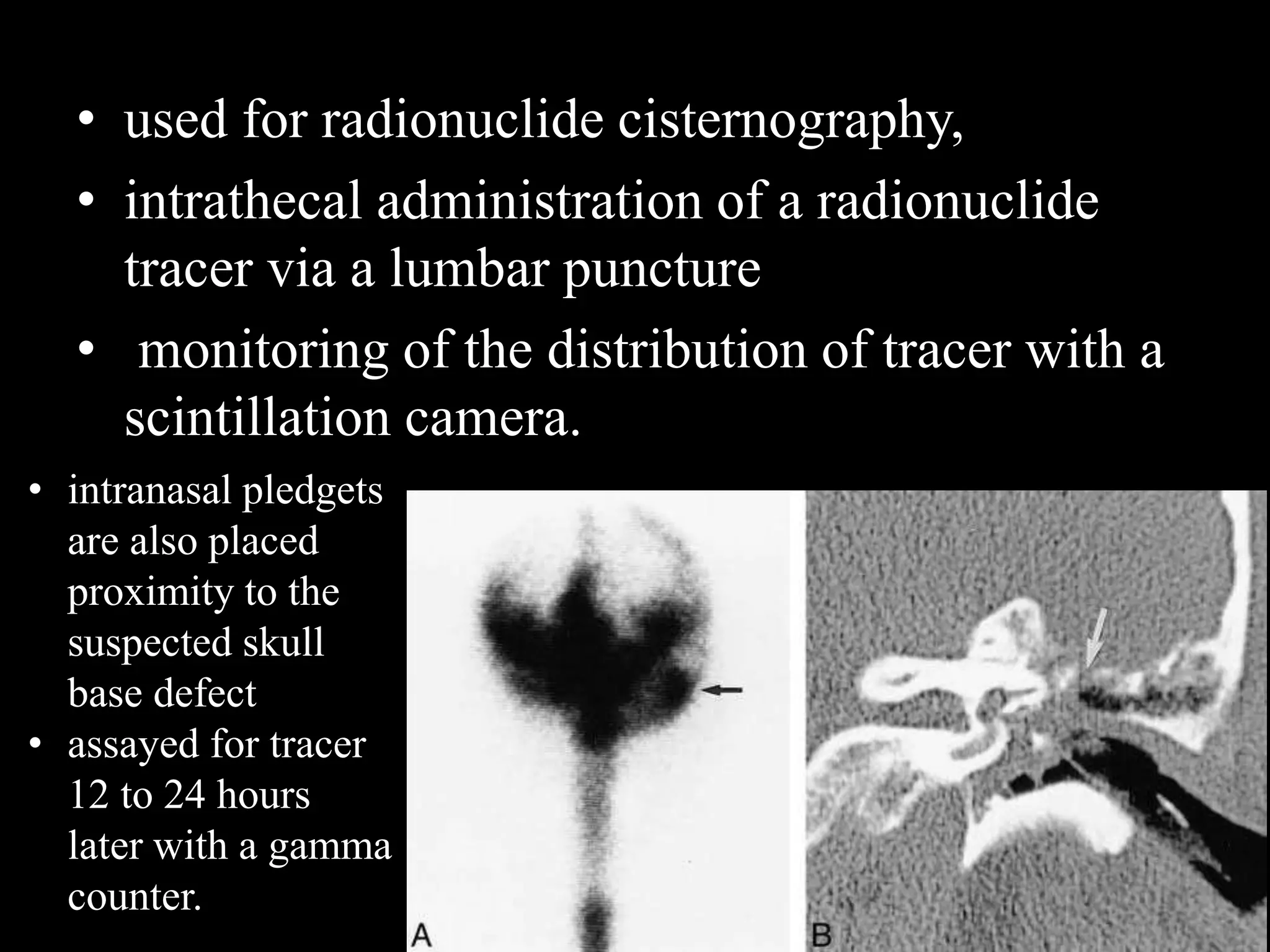 Cerebrospinal fluid rhinorrhea (CSF) | PPTX