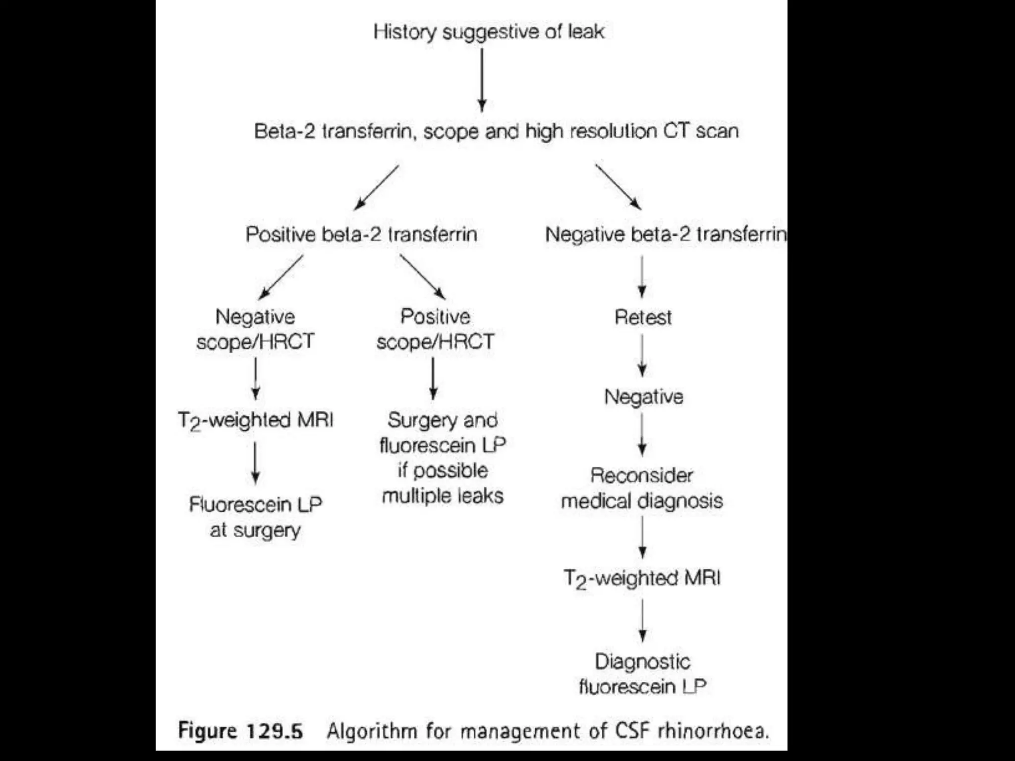 Cerebrospinal fluid rhinorrhea (CSF) | PPTX