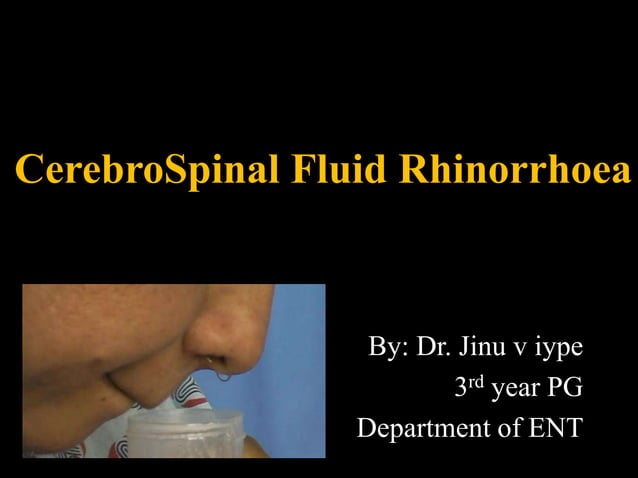 Cerebrospinal fluid rhinorrhea (CSF) | PPTX | Death, Injury, or ...